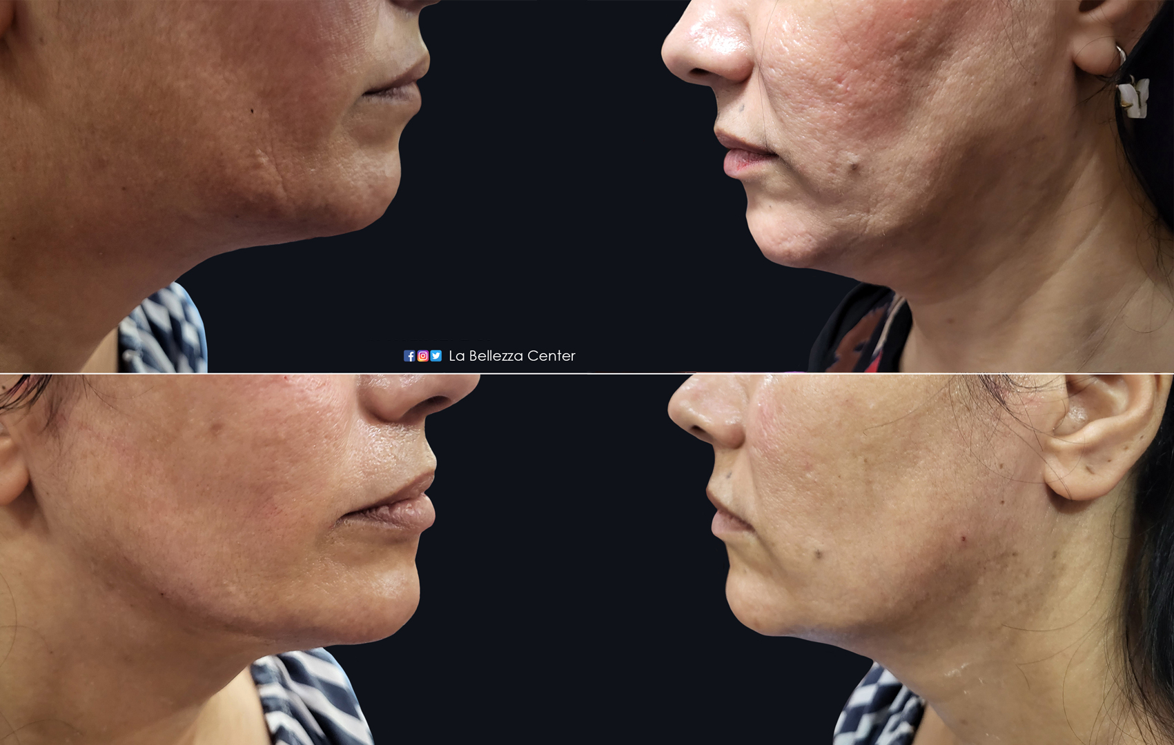 LOWER FACE FILLERS: Контурирање на долна третина на лицето - La ...